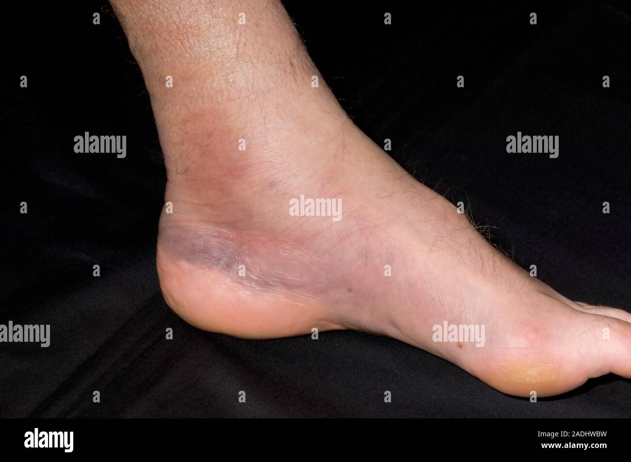 MODEL RELEASED. Bruised ankle. Haematoma (bruise) on the ankle of a 56 ...