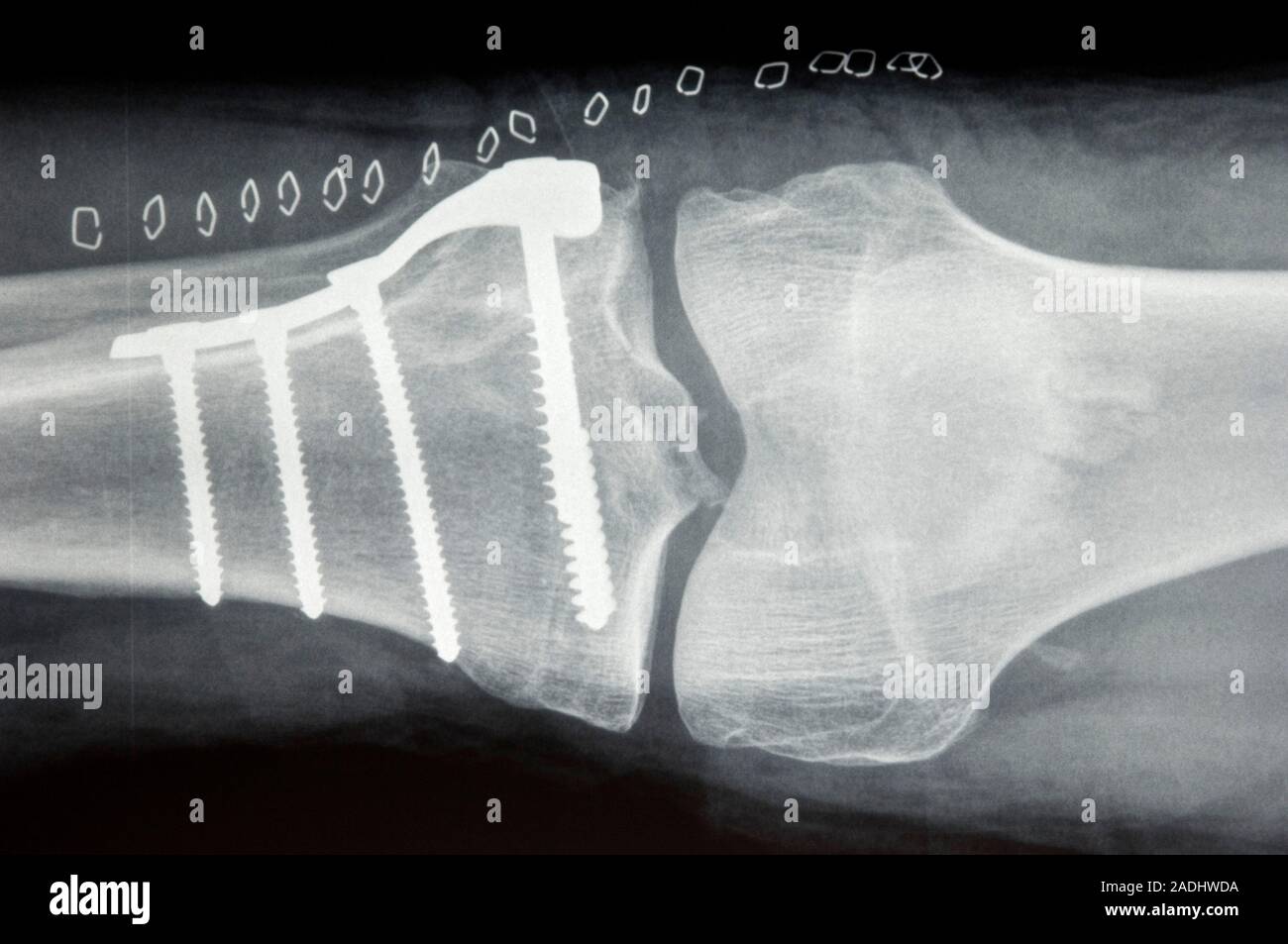 Pinned broken leg. X-ray of a 56 year old man's pinned broken leg. The ...
