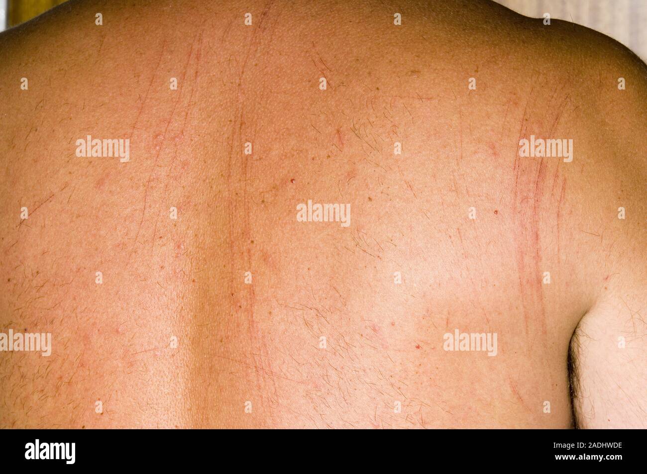 MODEL RELEASED. Scratched back. Scratches on a 44 year old man's back ...