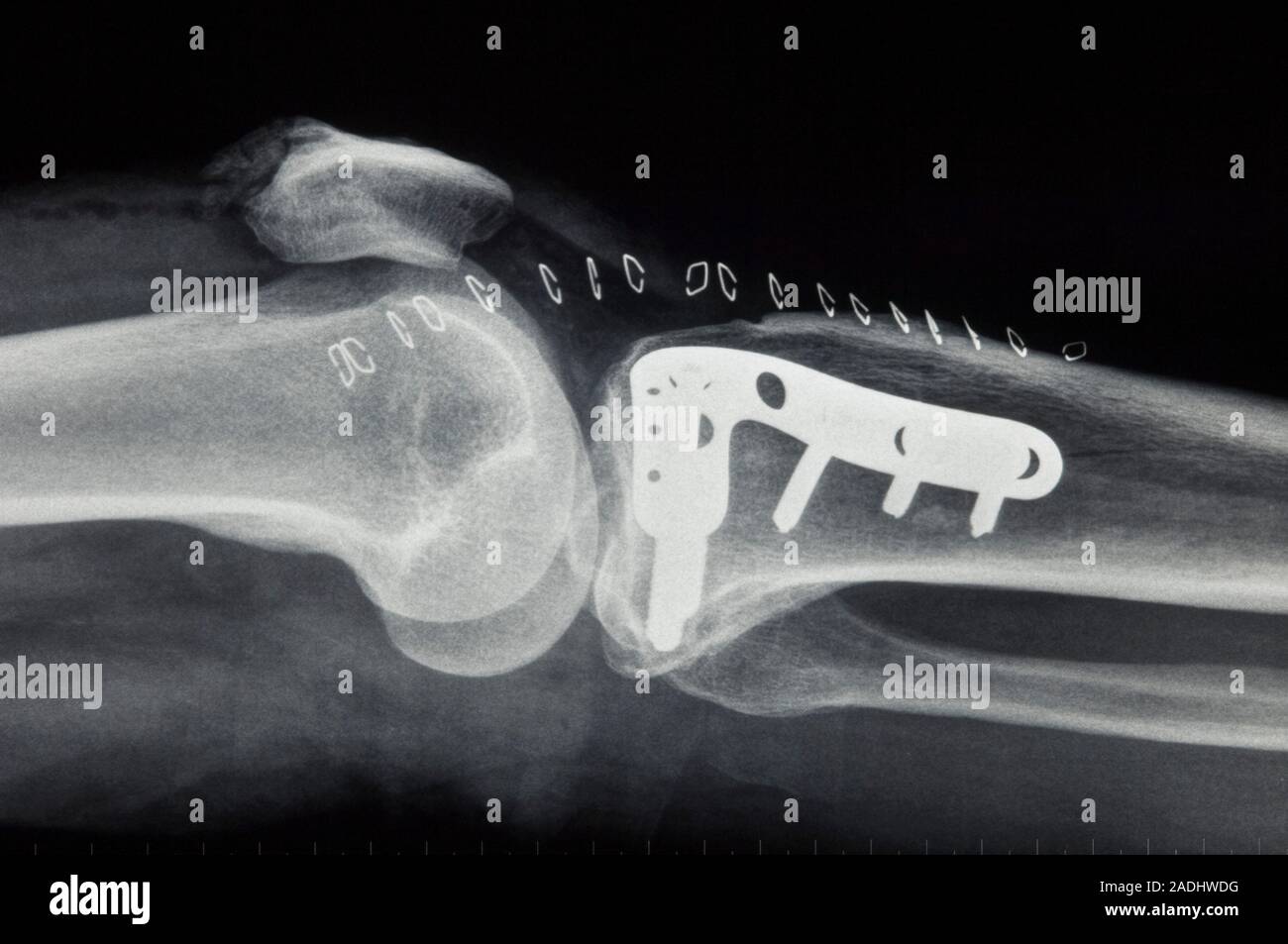 Pinned broken leg. X-ray of a 56 year old man's pinned broken leg. The ...