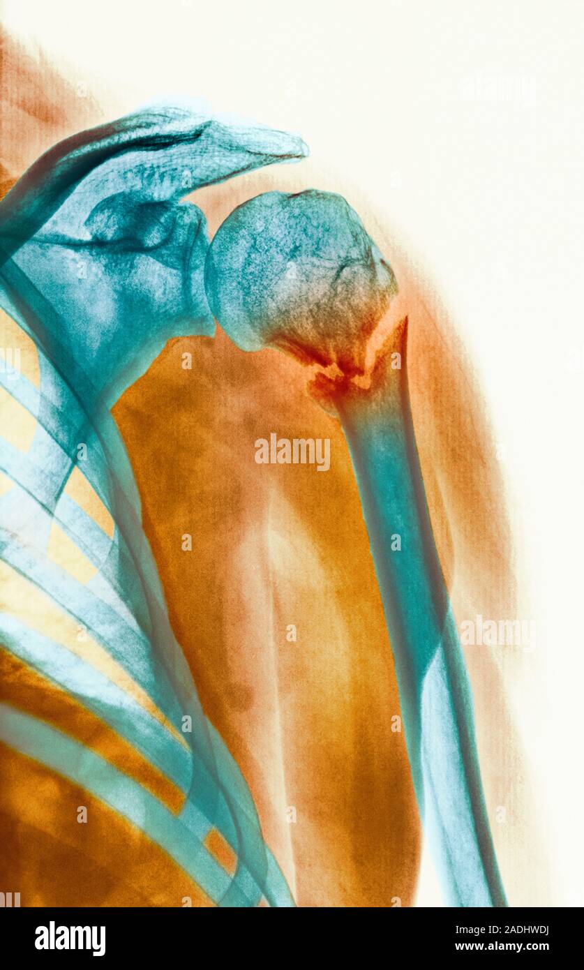 Broken upper arm bone. Coloured X-ray of the shoulder and arm of an ...