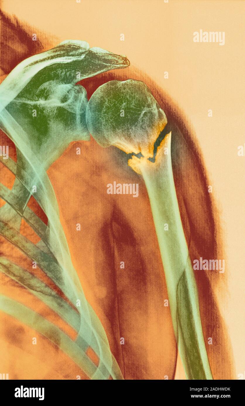 Broken upper arm bone. Coloured X-ray of the shoulder and arm of an ...