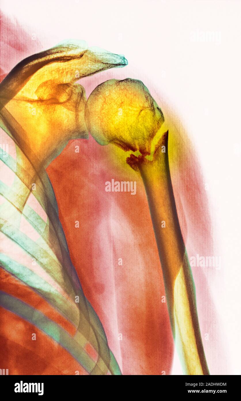 Broken upper arm bone. Coloured X-ray of the shoulder and arm of an ...