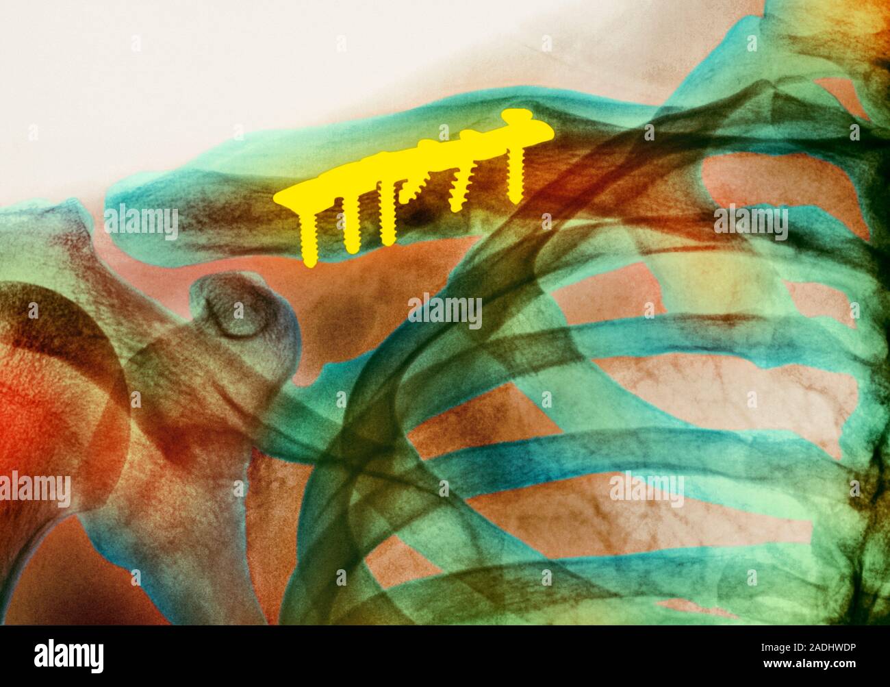 Pinned collar bone fracture. Coloured X-ray of the shoulder of a 24 ...