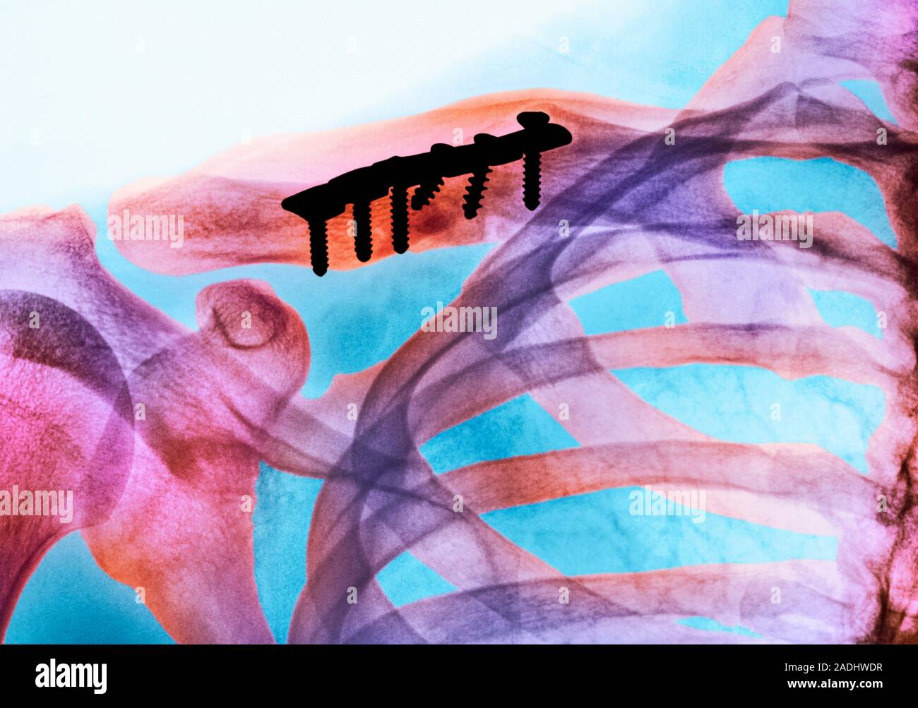 Pinned collar bone fracture. Coloured X-ray of the shoulder of a 24 ...