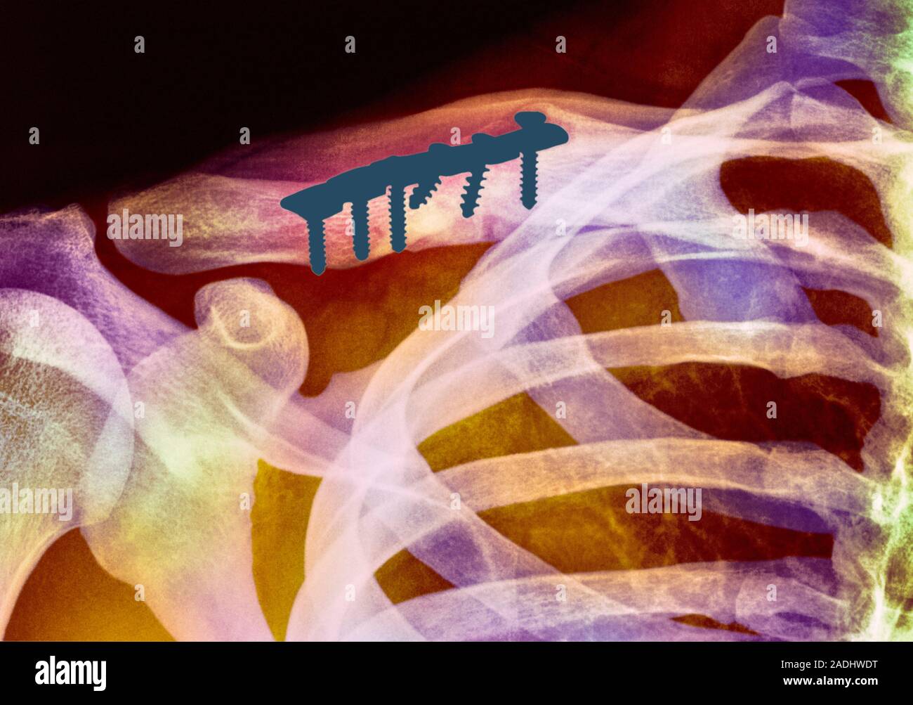 Pinned collar bone fracture. Coloured X-ray of the shoulder of a 24 ...