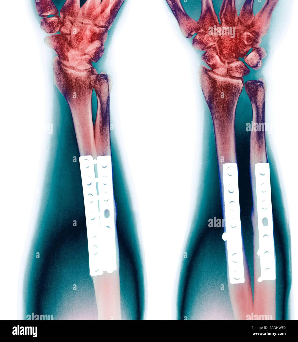 Pinned broken arm (2 views). Coloured X-ray of the forearm of a 34 year ...