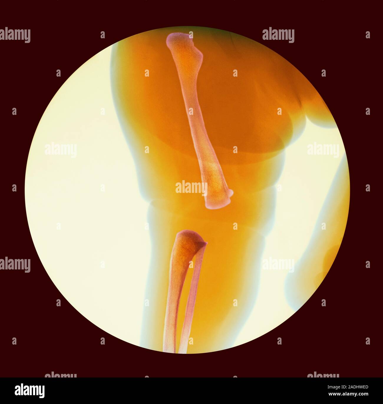 Congenital knee dislocation. Coloured X-ray of the dislocated and ...