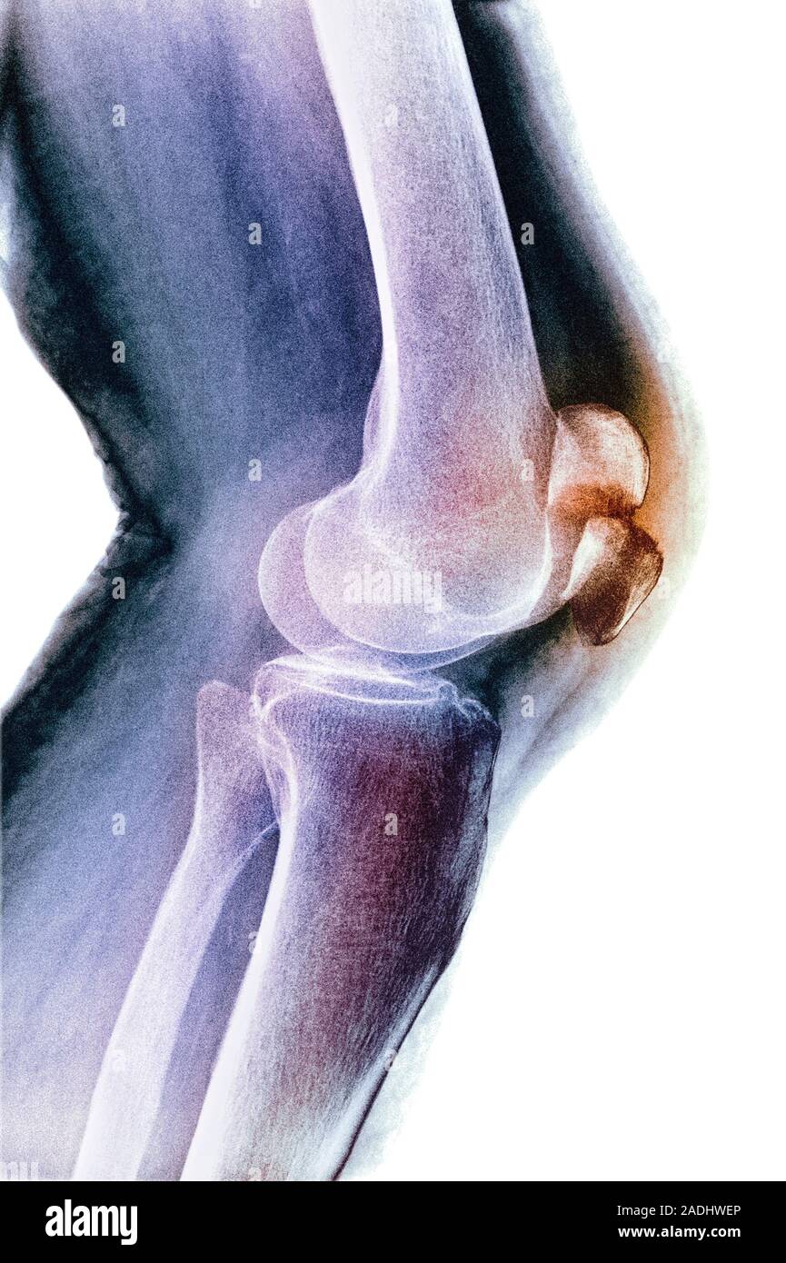 Fractured kneecap. Coloured X-ray of a side-view of the leg of a ...