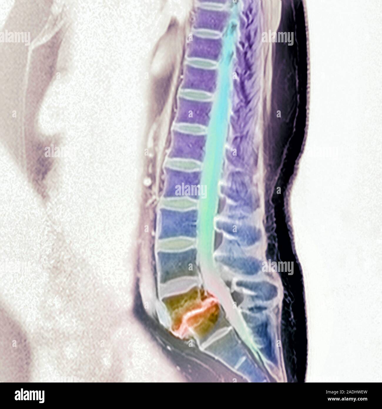 Slippage of a vertebra (anterolisthesis). Coloured magnetic resonance ...
