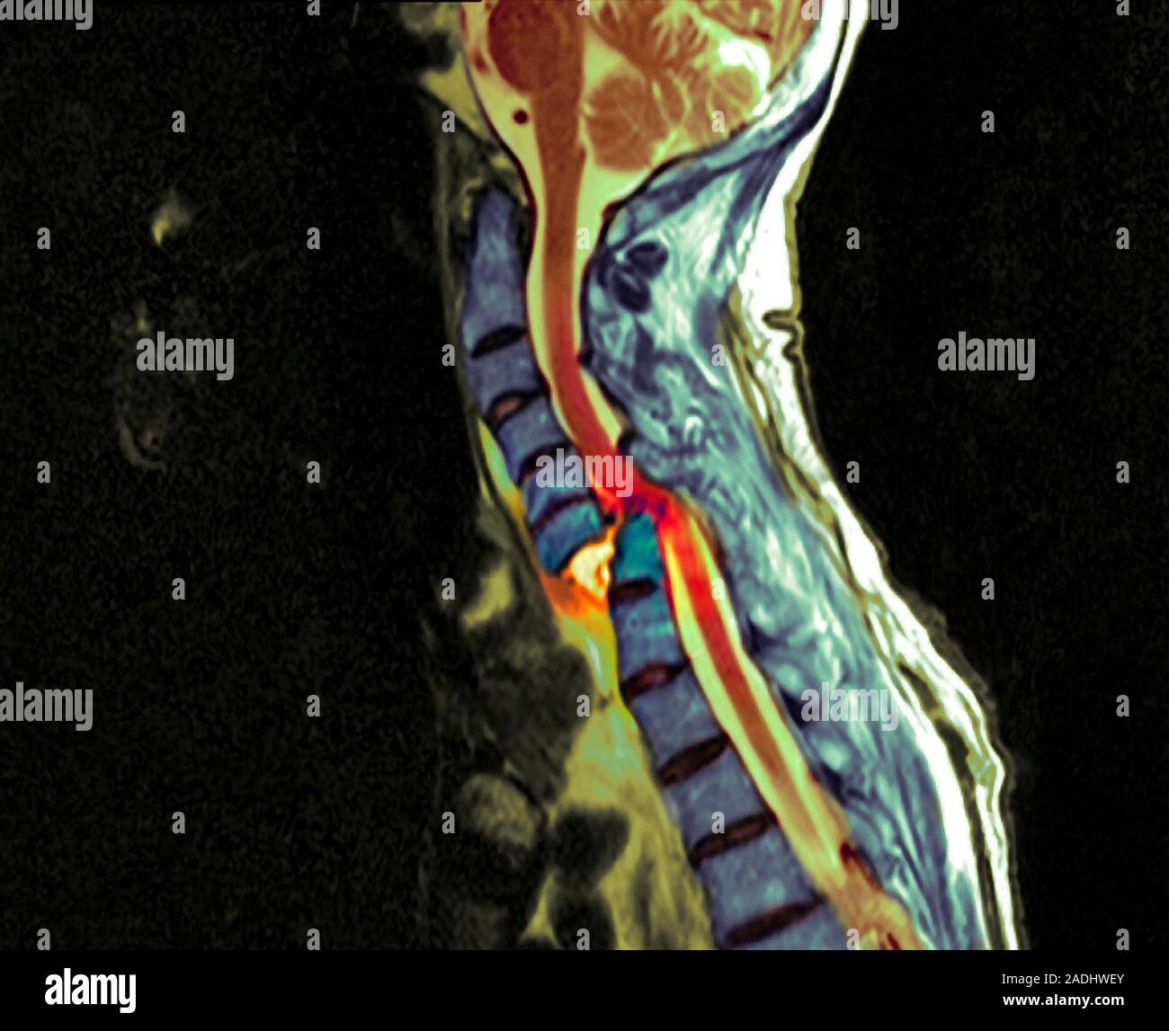 Fractured spine. Coloured magnetic resonance imaging (MRI) scan showing ...