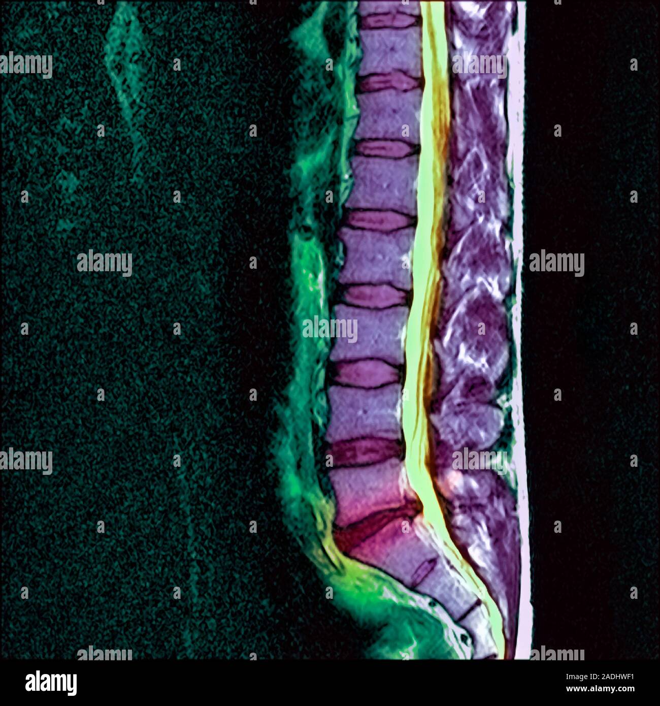 Slipped disc. Coloured magnetic resonance imaging (MRI) scan of the ...