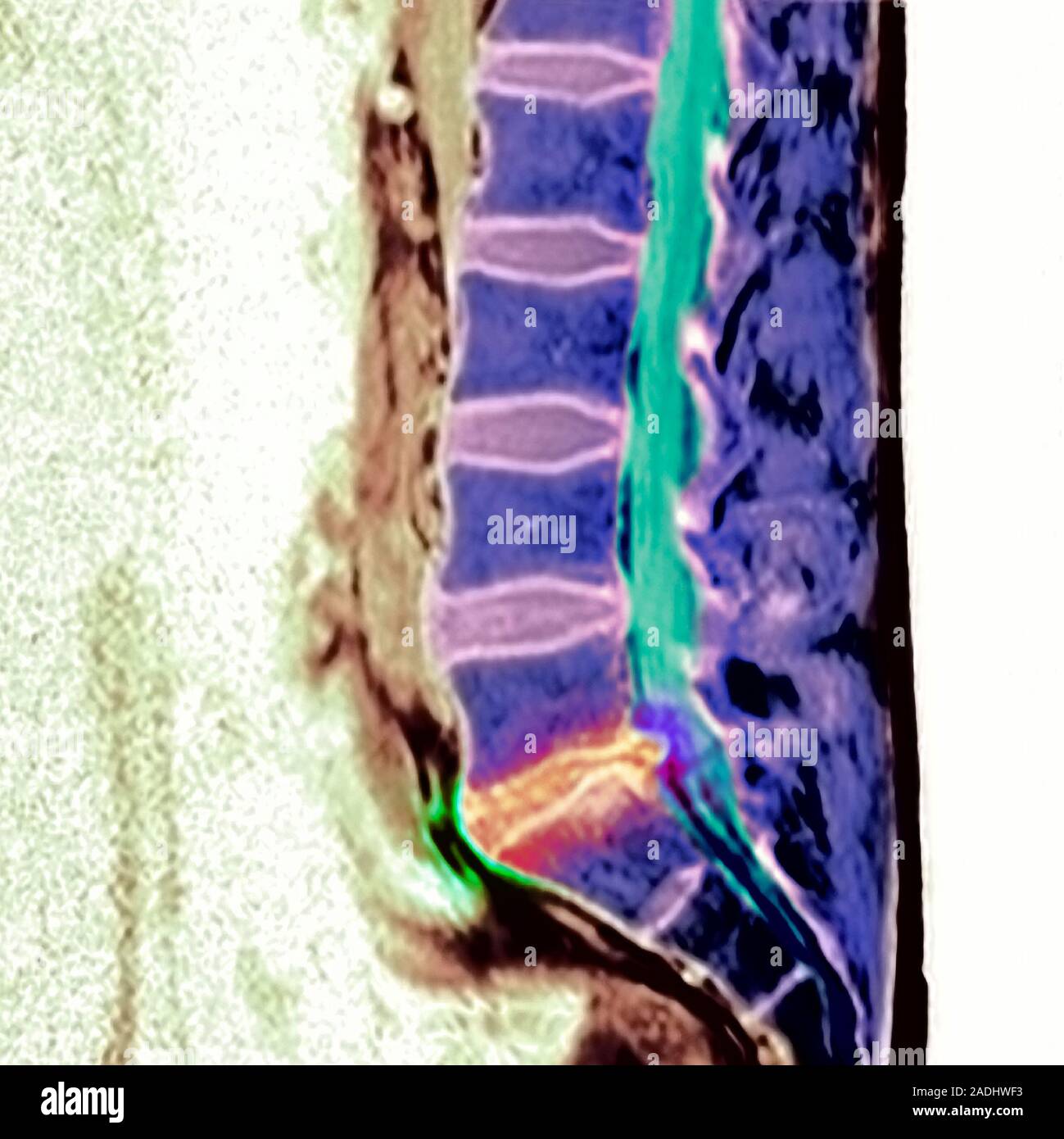 Slipped disc. Coloured magnetic resonance imaging (MRI) scan of the ...
