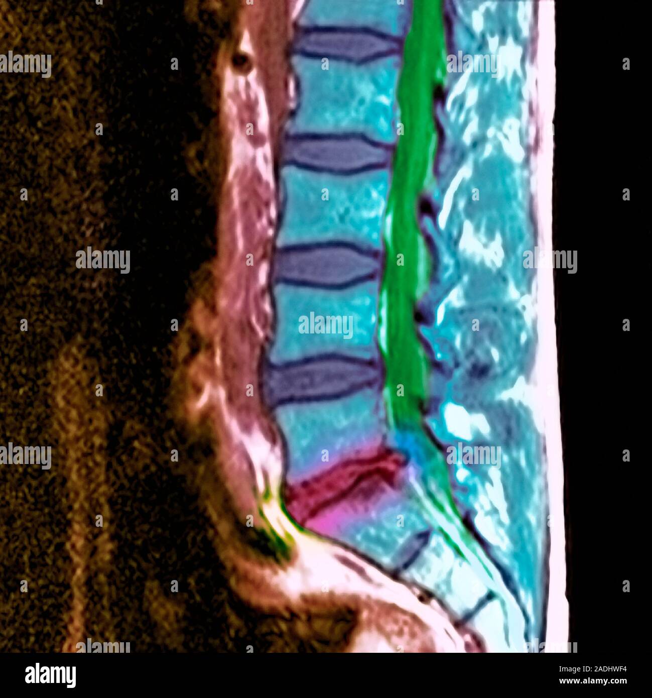 Slipped disc. Coloured magnetic resonance imaging (MRI) scan of the ...