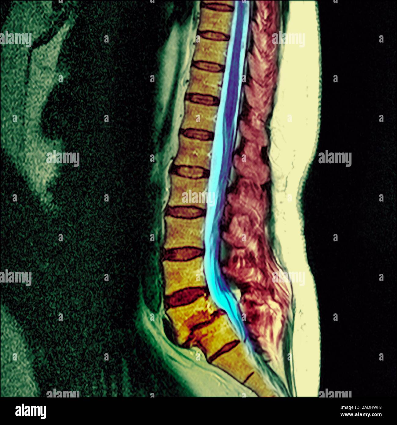 Slippage of a vertebra (anterolisthesis). Coloured magnetic resonance ...