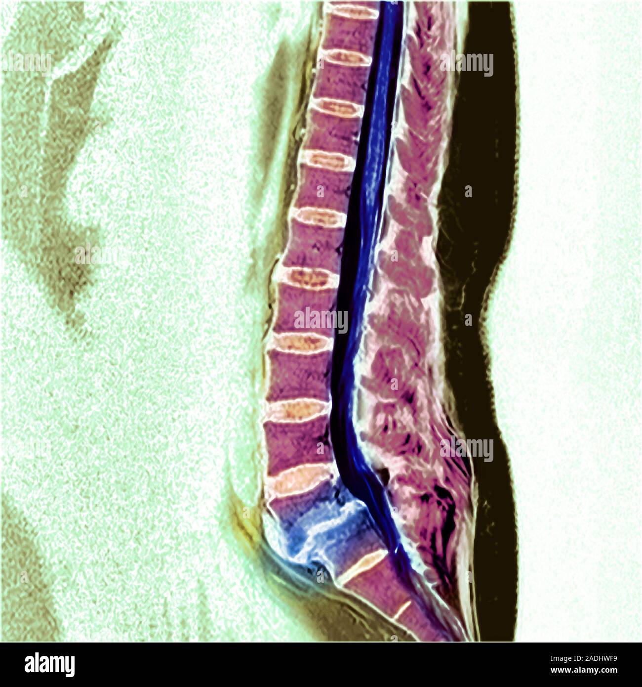 Slippage of a vertebra (anterolisthesis). Coloured magnetic resonance ...