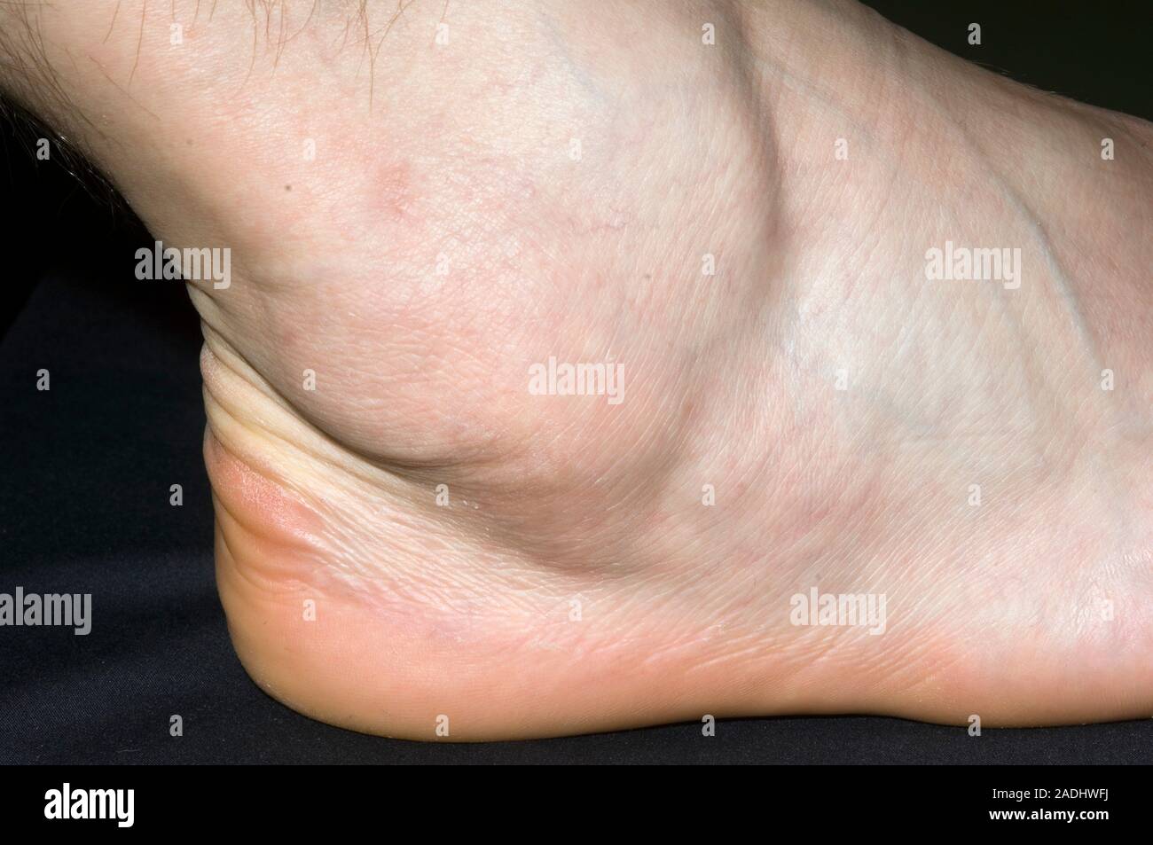 MODEL RELEASED. Swollen ankle. 24 year old man with a persistent ...