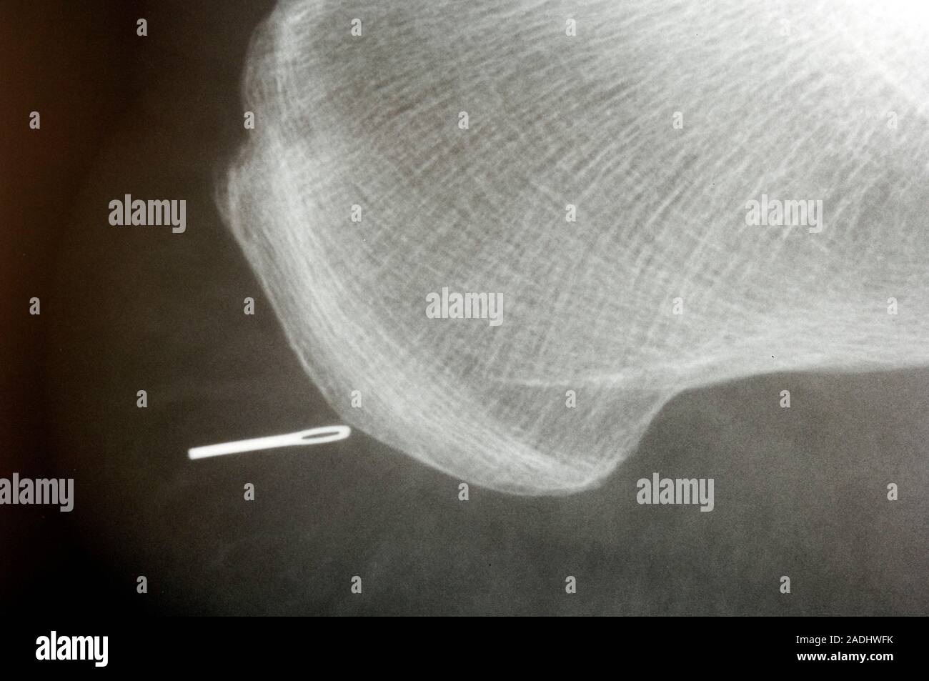 Sewing needle stuck in foot. X-ray of a broken sewing needle stuck in ...