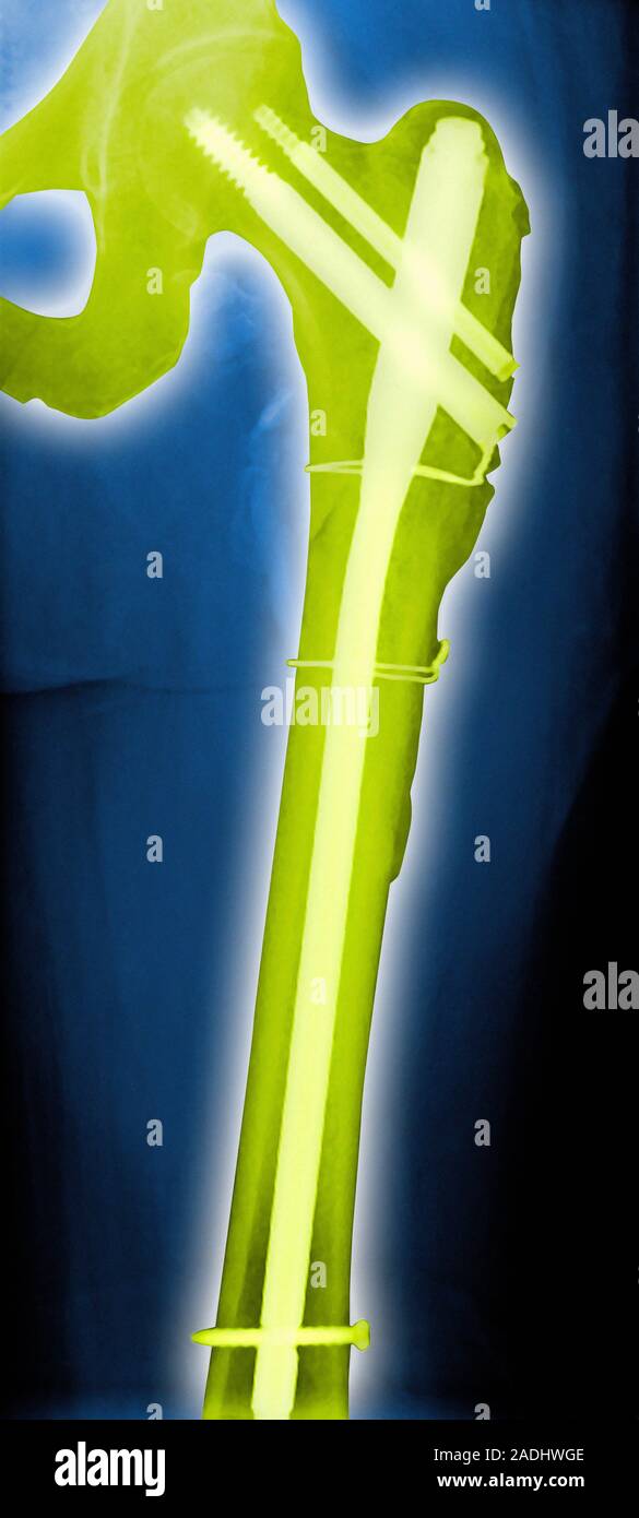 Pinned broken leg, coloured X-ray. The patient's femur (thigh bone) has ...