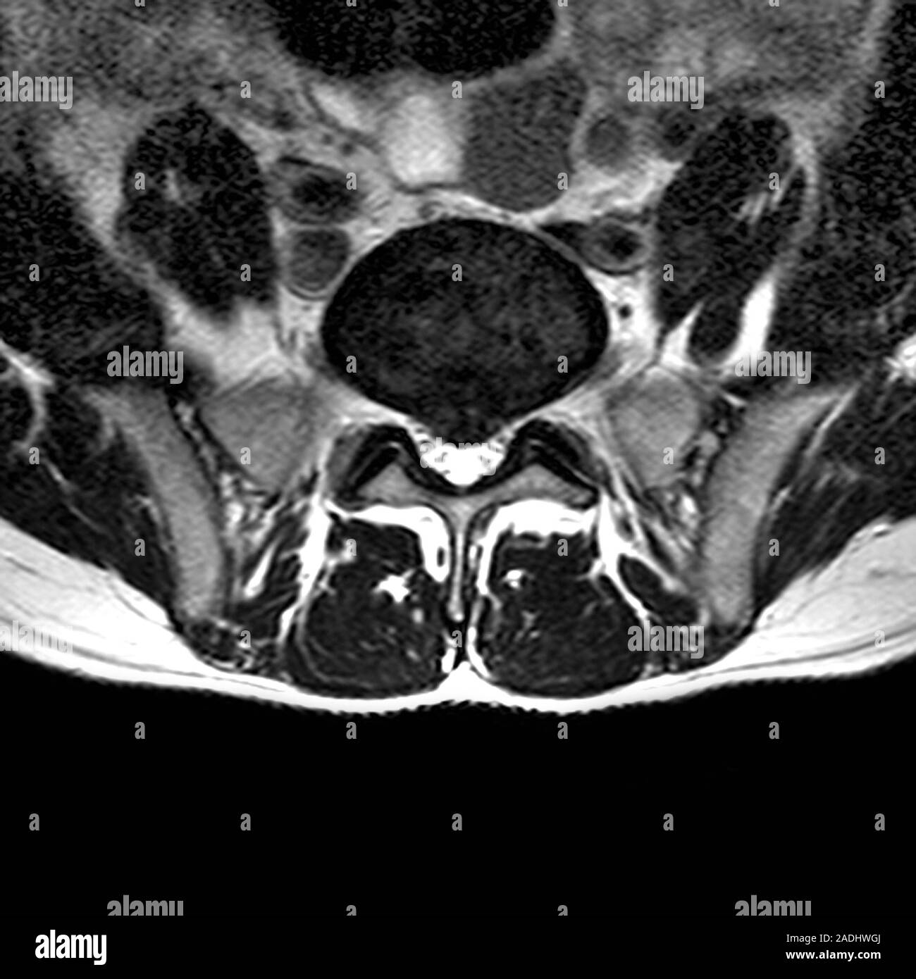 Slipped disc. Magnetic resonance imaging (MRI) scan of an axial ...