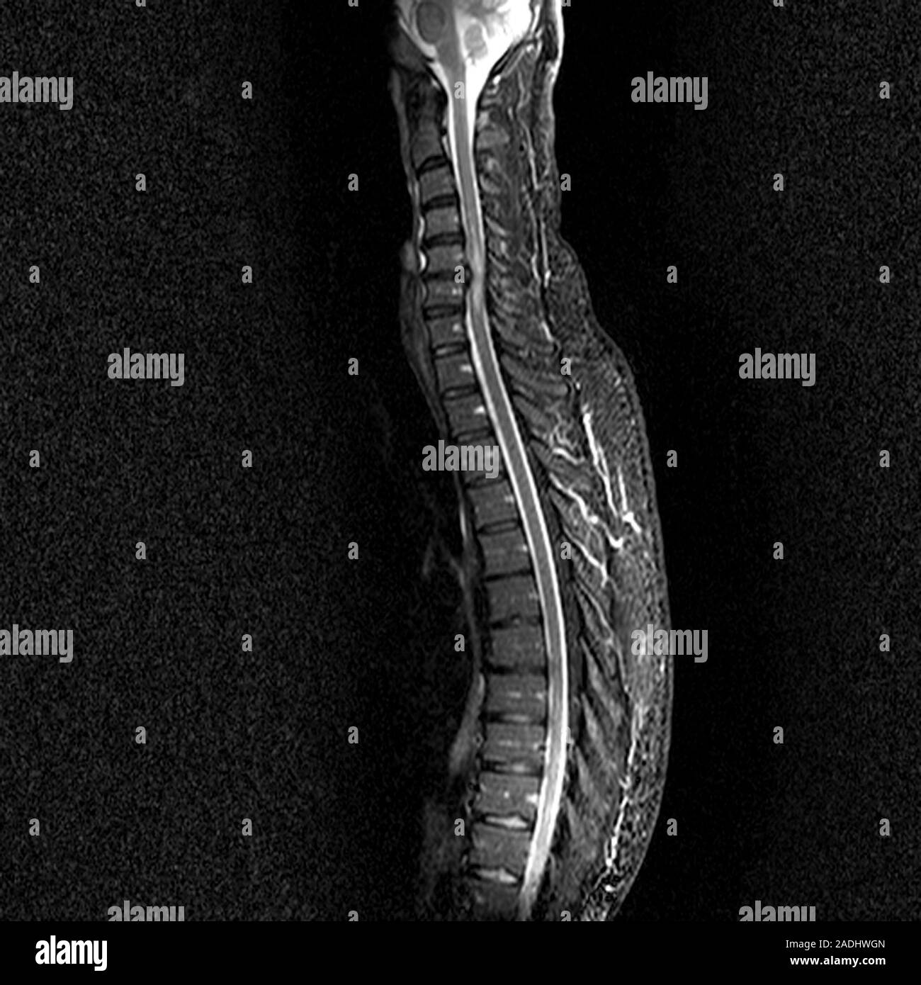 Slipped disc. Magnetic resonance imaging (MRI) scan of a sagittal (side ...