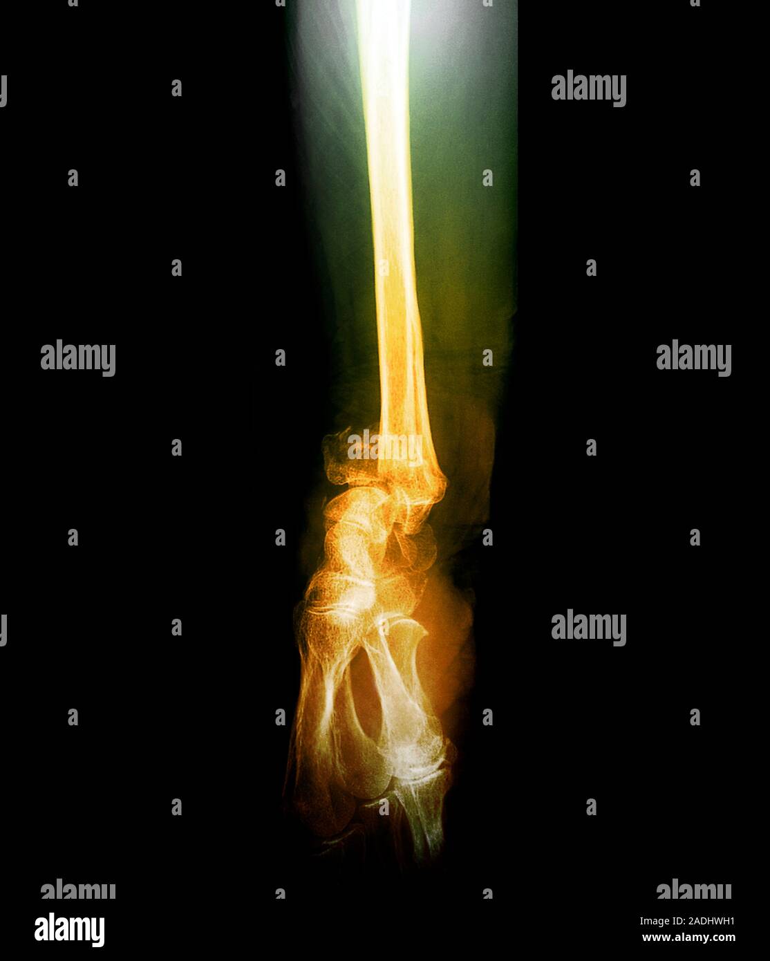 Colles' wrist fracture. Coloured profile X-ray of the hand and wrist ...