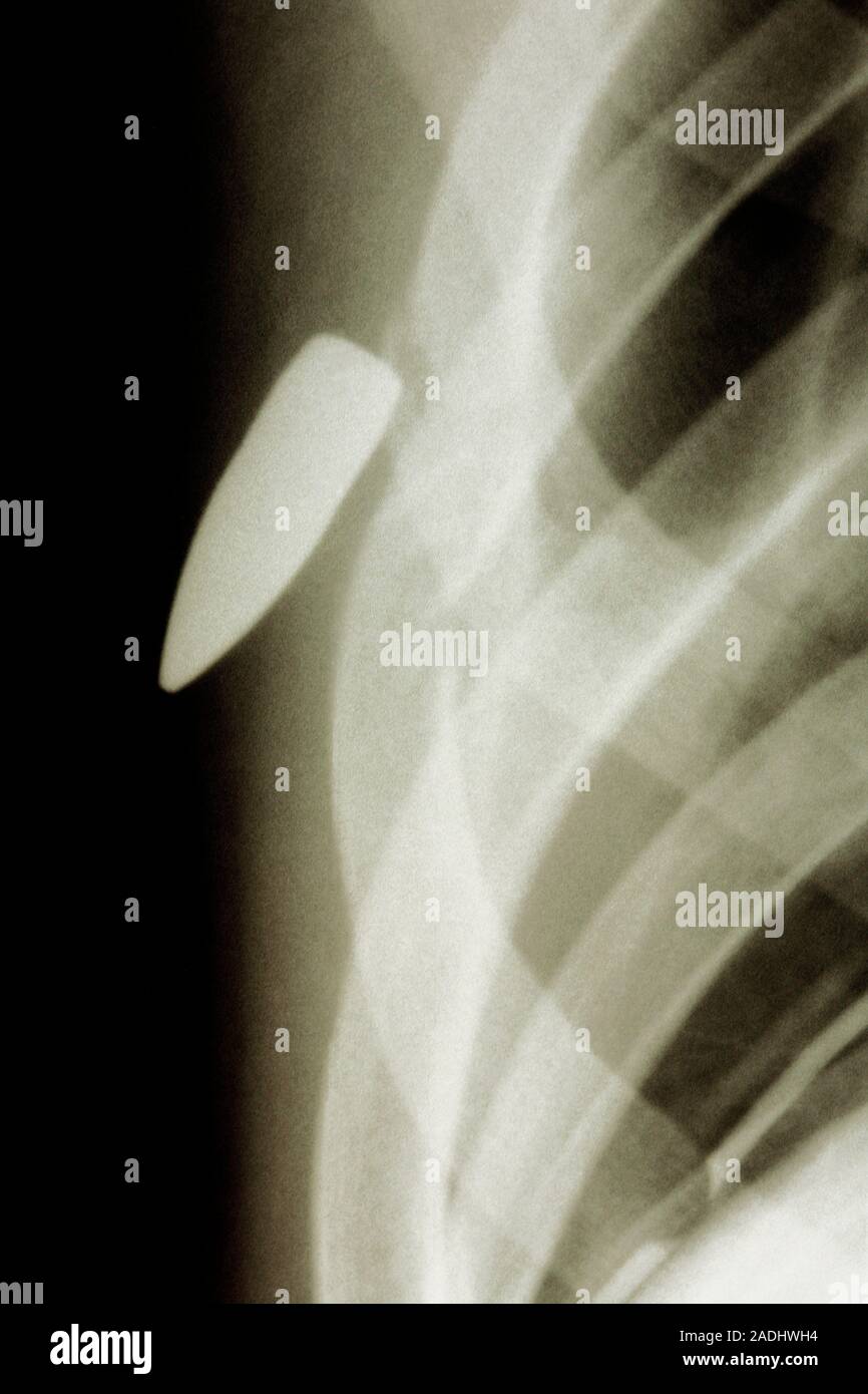 Firearm injury. X-ray of a bullet (conical object at centre left ...