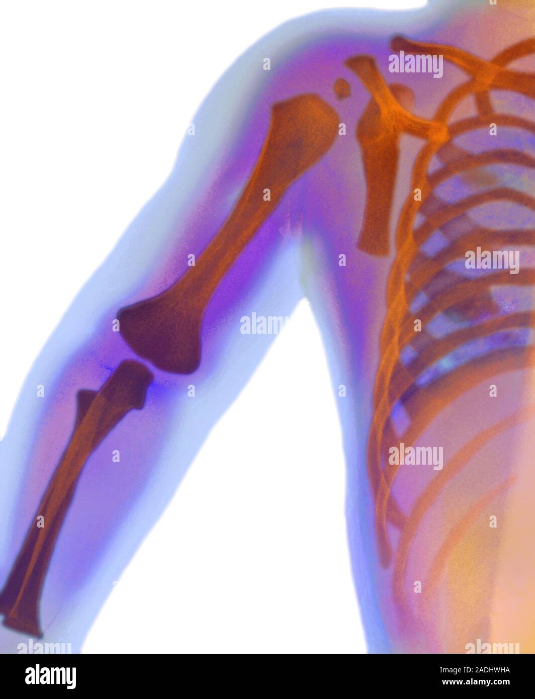 Fractured shoulder. Coloured X-ray of a 3 year old boy's fractured ...