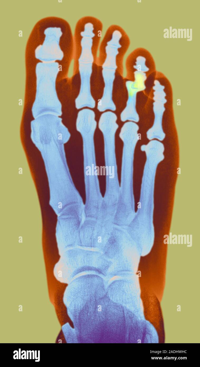 Dislocated toe. Coloured X-ray of the foot of a 49 year old woman with ...