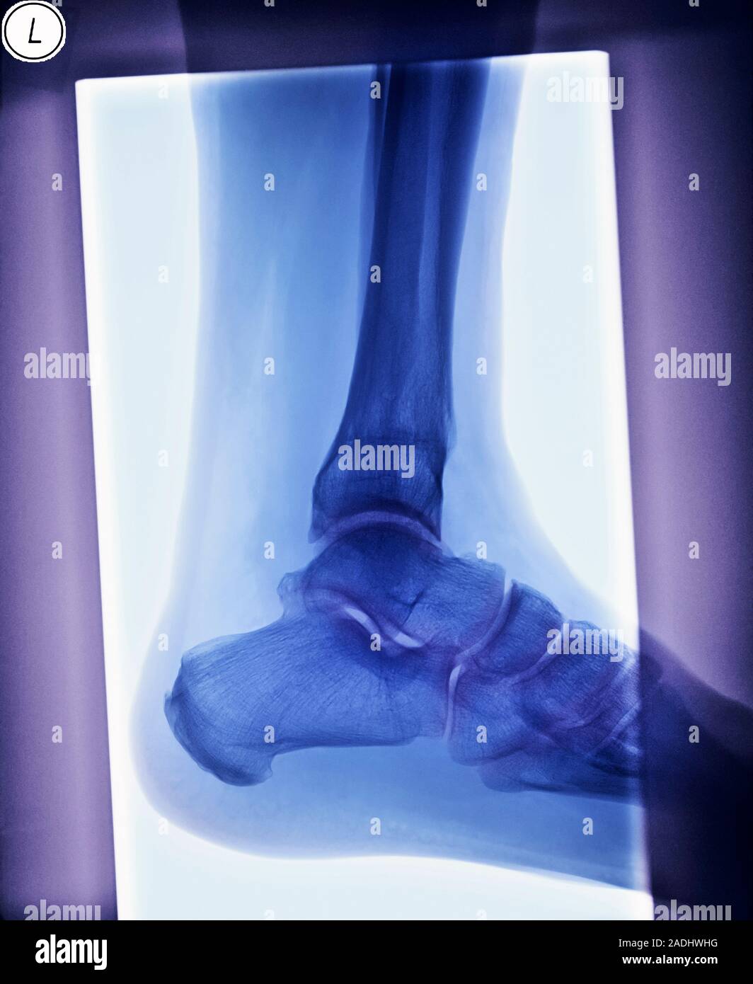 Deformed ankle after fracture. Coloured profile X-ray of the left ankle ...
