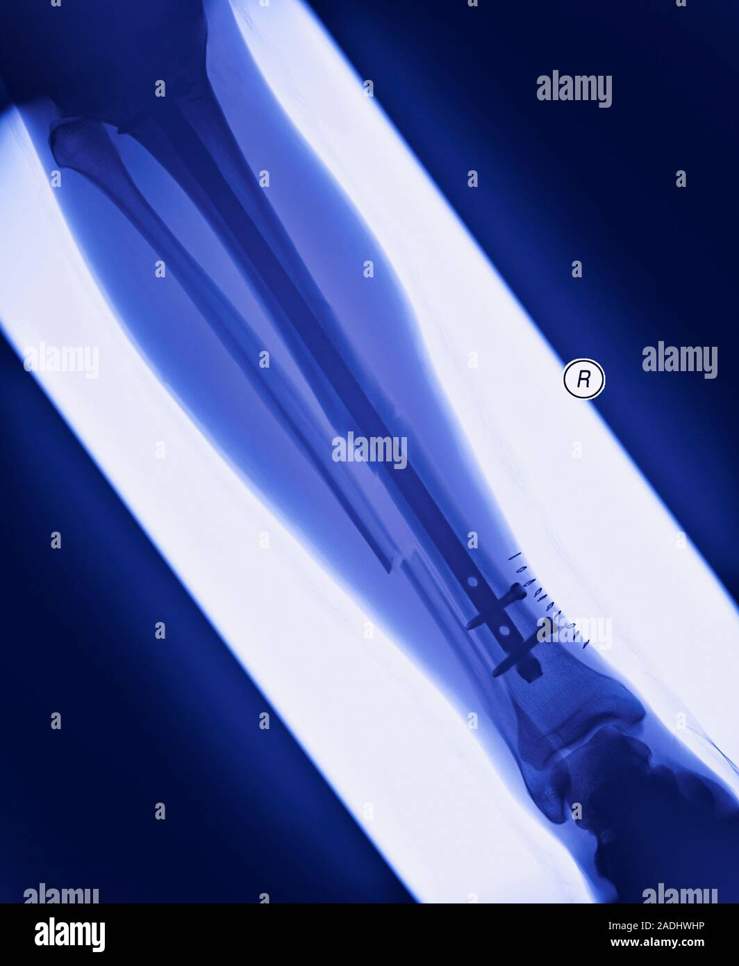 Pinned leg fracture. Coloured X-ray of a metal plate and screws ...