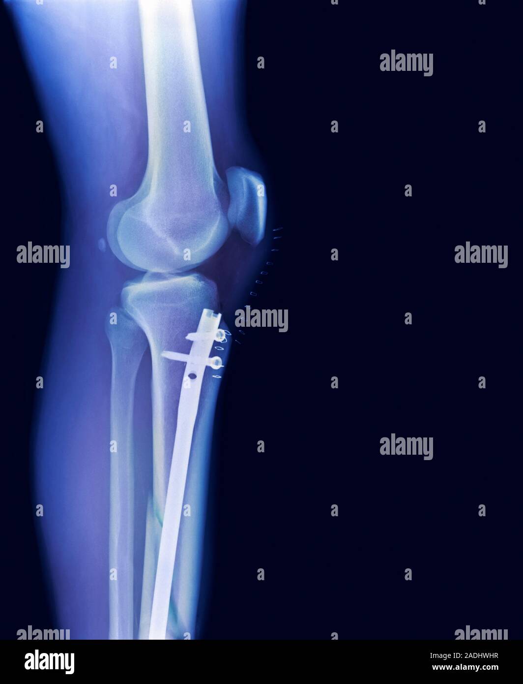 Pinned leg fracture. Coloured side view X-ray of a metal plate and ...