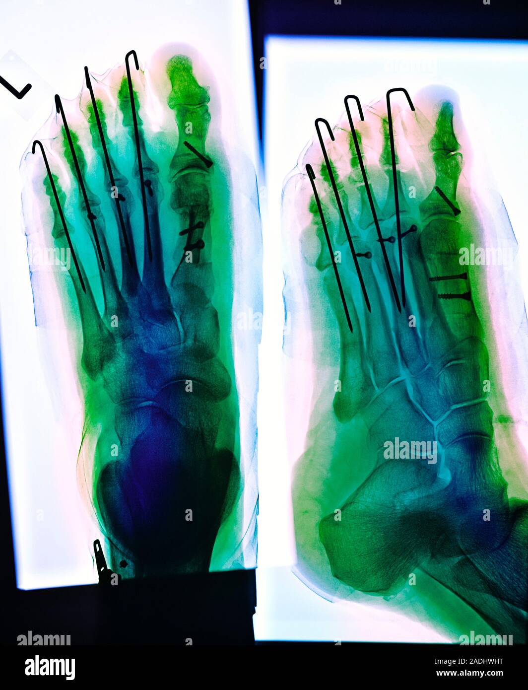 Pinned foot. Coloured X-rays of the left foot of a female patient ...