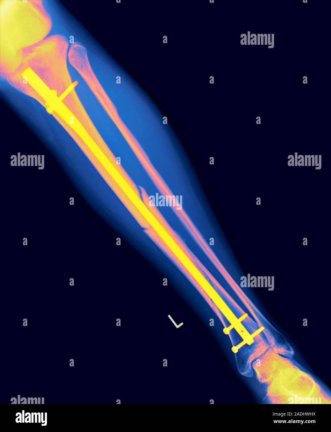 Pinned leg fracture. Coloured X-ray of a metal plate and screws (yellow ...
