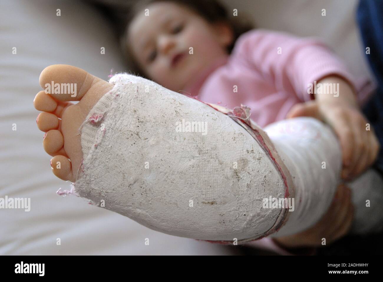 MODEL RELEASED. Broken leg. Plaster cast on a young girl's broken leg ...