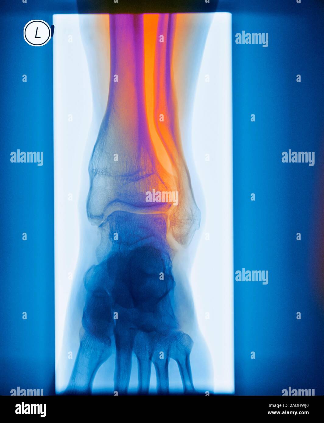 Deformed ankle after fracture. Coloured frontal X-ray of the left ankle ...