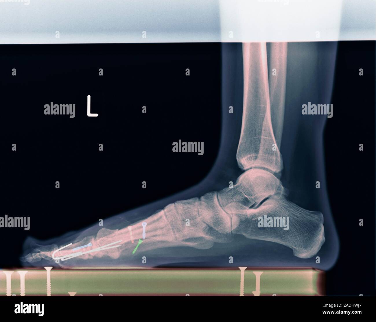 Pinned foot. Coloured side view X-ray of the left foot of a female ...