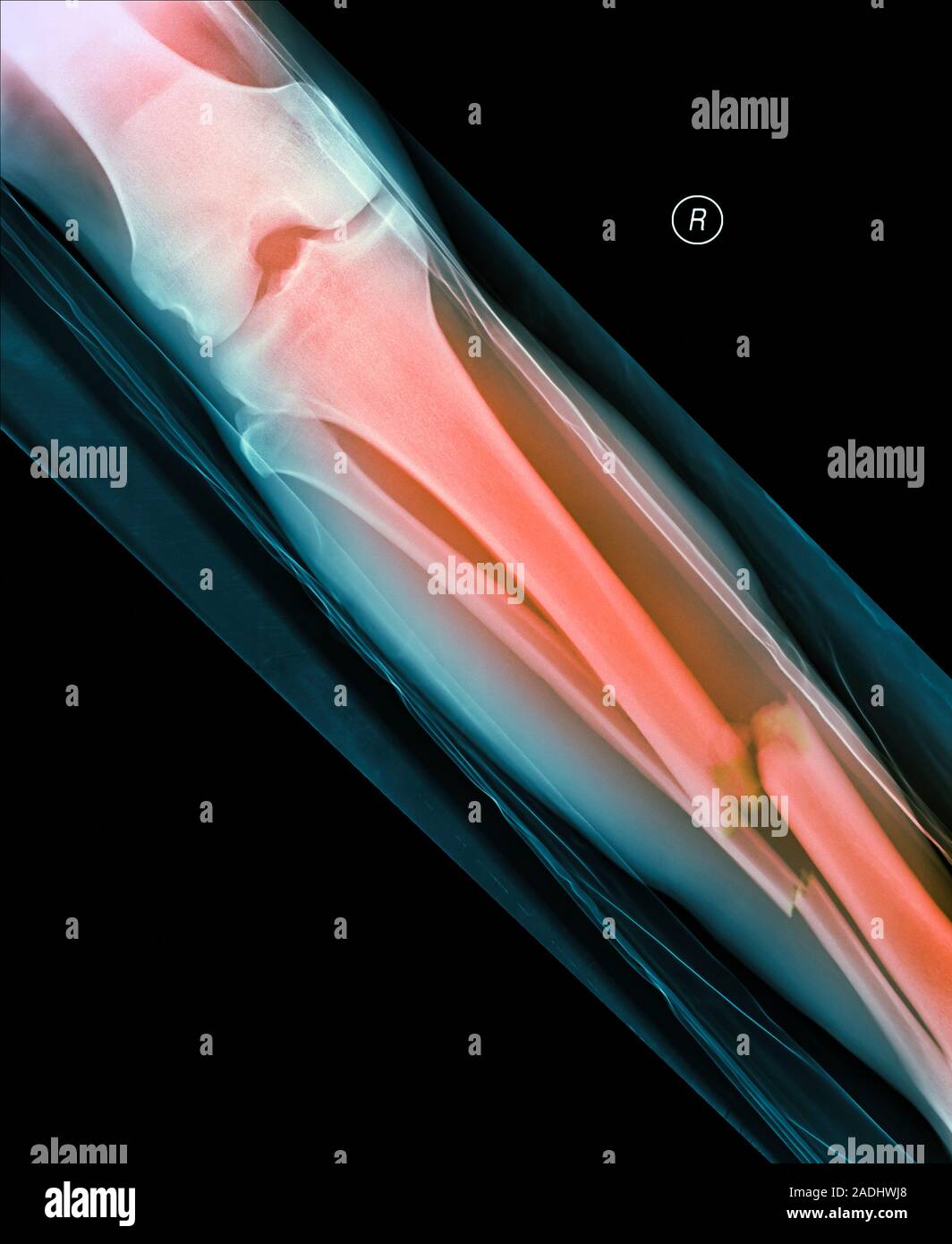 Fractured leg bones. Coloured X-ray of a double fracture in the lower ...