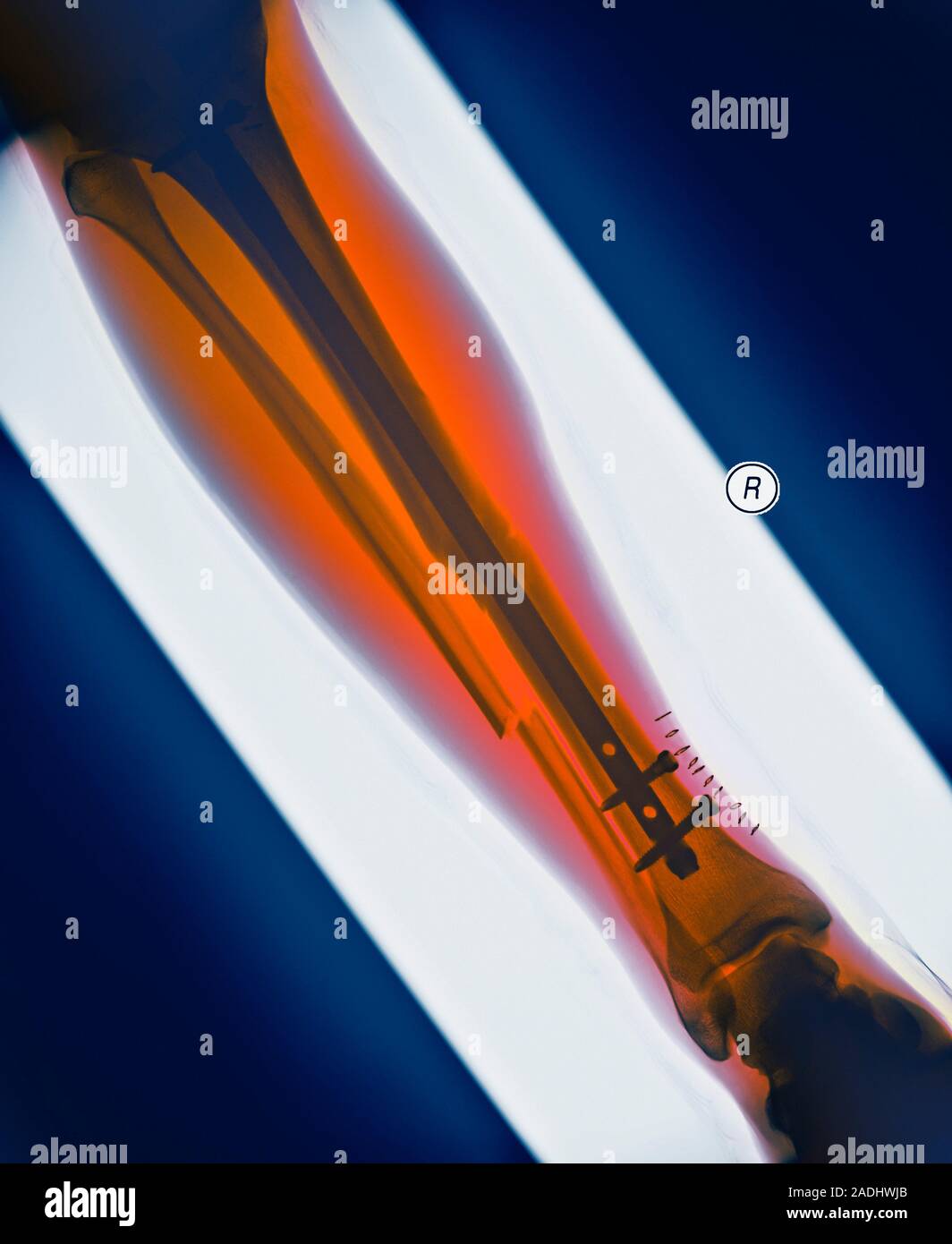 Pinned leg fracture. Coloured X-ray of a metal plate and screws ...