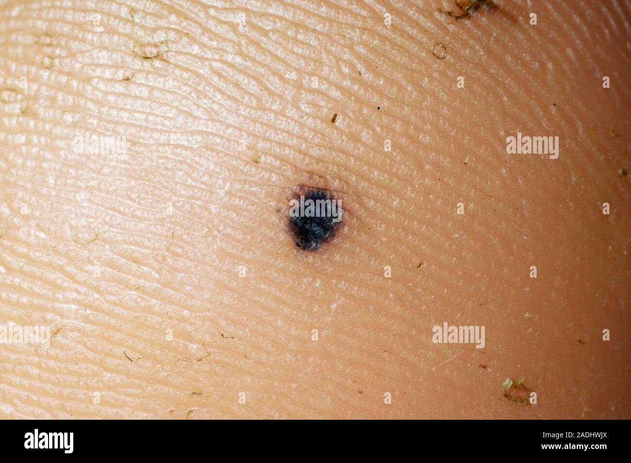 MODEL RELEASED. Small bruise (haematoma) on the heel of a 7-year-old ...