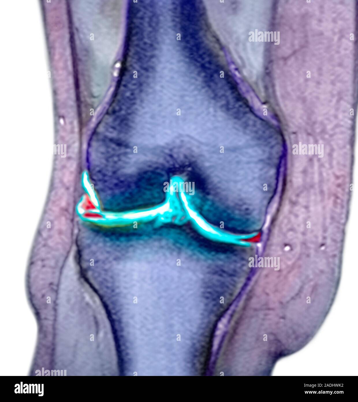 MODEL RELEASED. Knee meniscus tear. Coloured magnetic resonance imaging ...