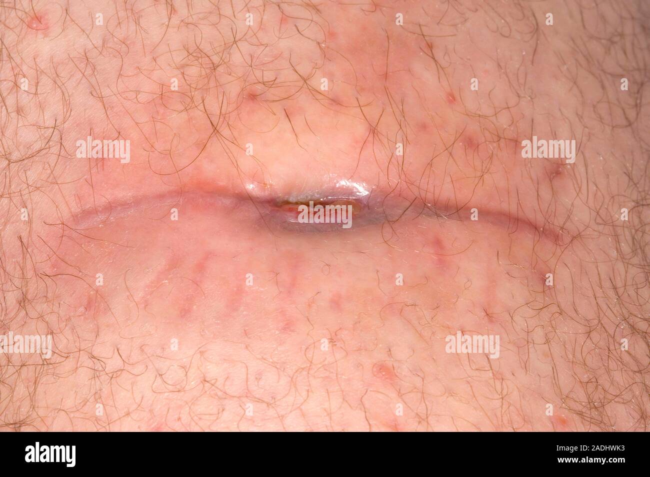 Infected cut on a 38-year-old man's thigh. The laceration, caused by an ...