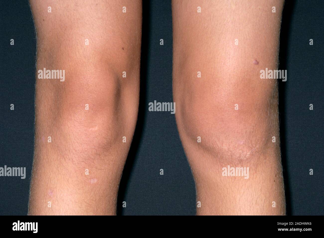 Normal and swollen (right) knees of a 14-year-old boy. The cause of the ...