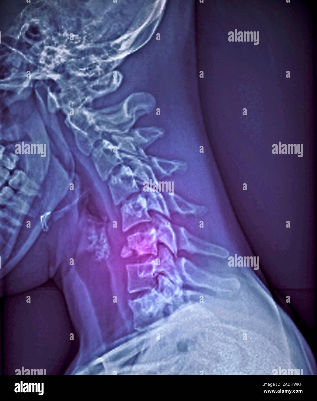 Fractured neck. Coloured profile X-ray of the left side of a 23-year ...