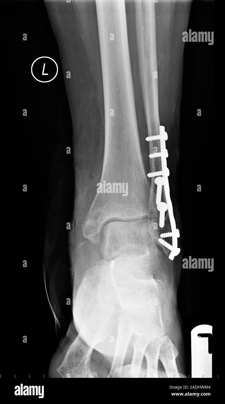 Pinned ankle fracture. Frontal X-ray of a metal plate and screws (white ...