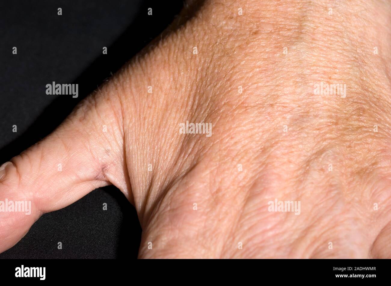 Muscle wasting. Hand of a 57-year-old man showing wasting of muscles ...