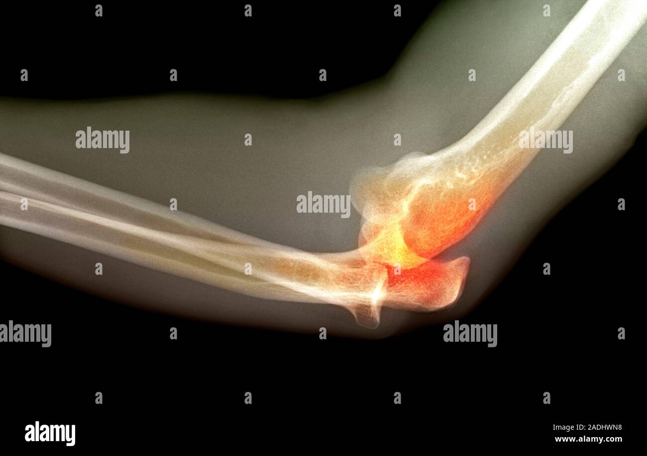 Dislocated elbow. Coloured lateral X-ray of an injury to the elbow ...