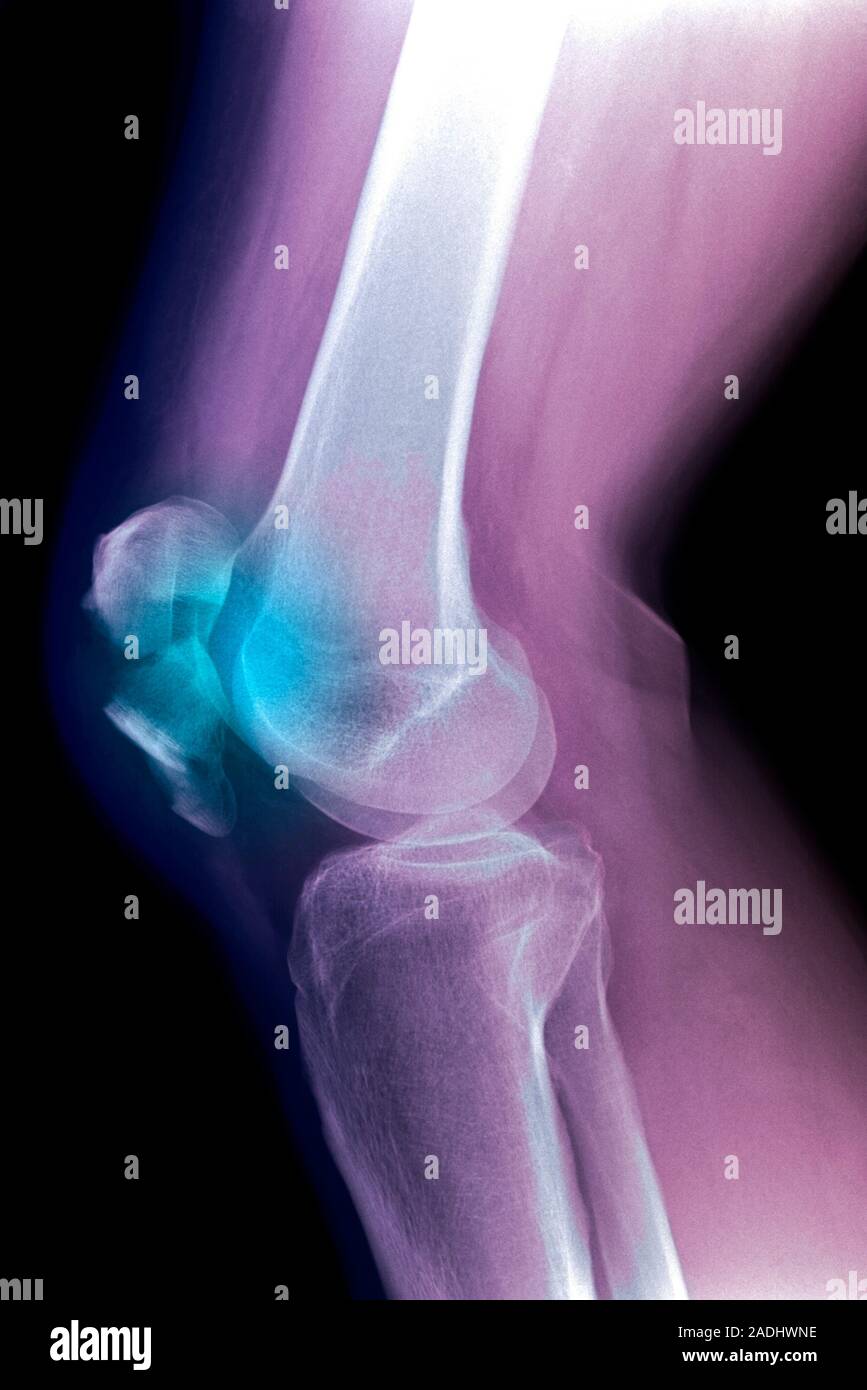 Kneecap fracture. Coloured X-ray of a broken kneecap (patella), as ...