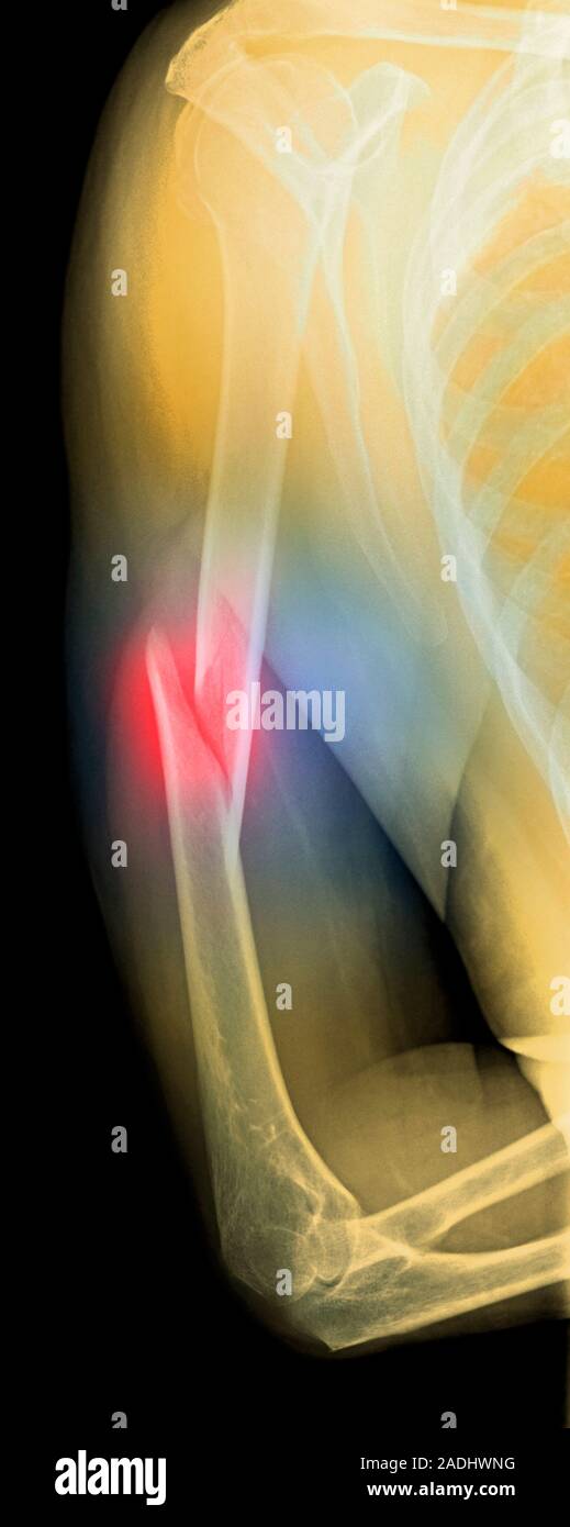 Fractured arm. Coloured X-ray of the front view of a fractured upper ...