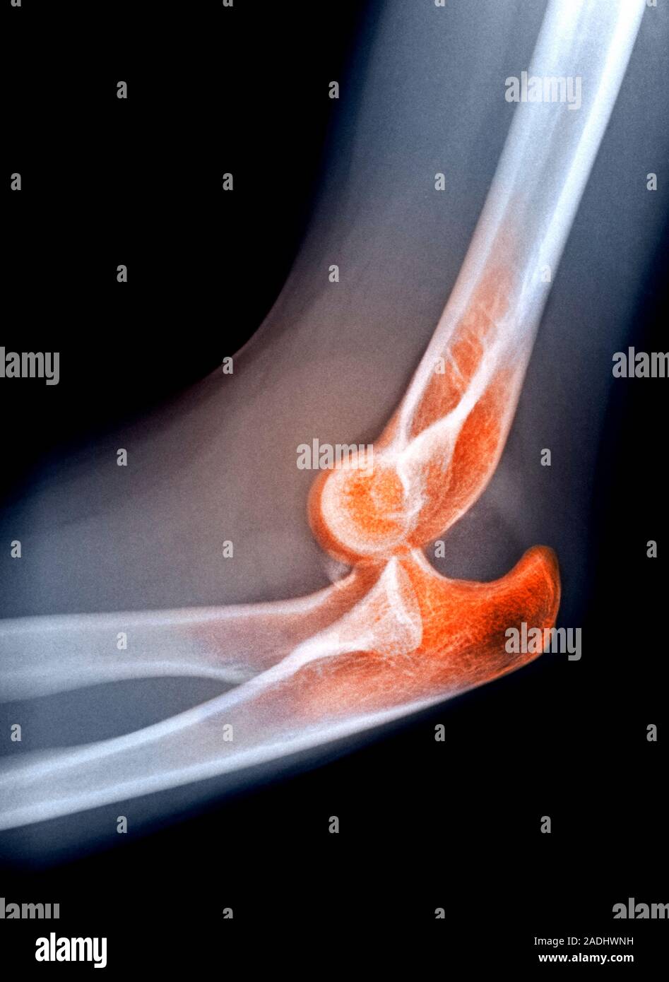 Dislocated elbow. Coloured lateral X-ray of an injury to the elbow ...